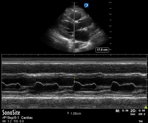 Heart Interpretation — Ultra Sono