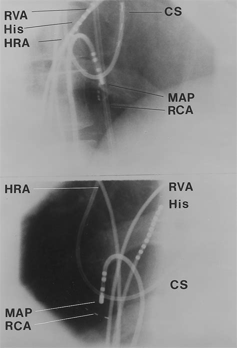 Radiofrequency Current Catheter Ablation Of Accessory Atrioventricular Pathways In Ebsteins