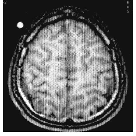 The Primary Motor Cortex Was Shown In Coloured Preoperative F MRI Download Scientific Diagram
