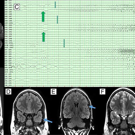 Pdf Long Term Seizure Freedom Following Invasive Monitoring