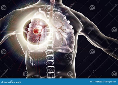 Fibrous Cavernous Pulmonary Tuberculosis Stock Illustration 114496453