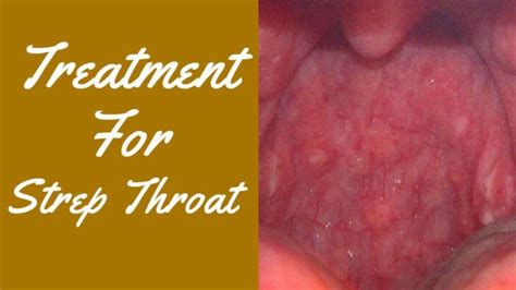 Treatment For Strep Throat: Apply These 6 Natural Remedies Without ...
