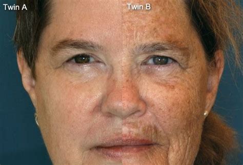 The Aging Process And UV Damage Symetrie