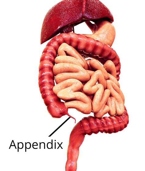Laxmi Homeo Clinic Appendicitis Reasons Treatment And Proven Cure