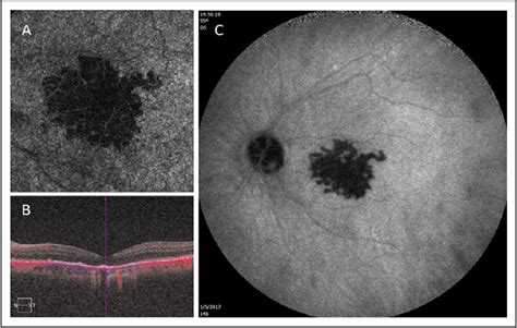 Figure 2 From Persistent Placoid Maculopathy Treatment Response Imaged