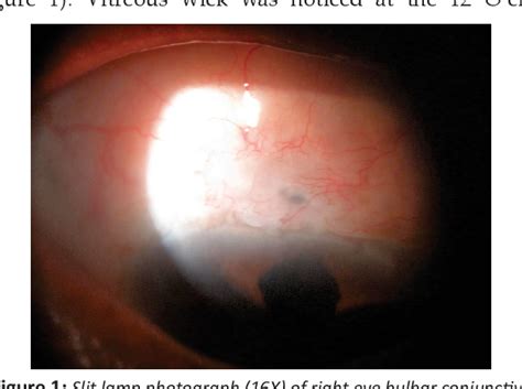 Figure 1 From Delayed Vitreous Blockade Of Trabeculectomy Ostium By Old