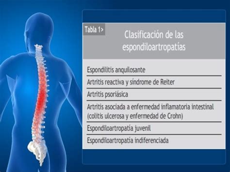 Espondiloartropatias Dr Enrique Menedez