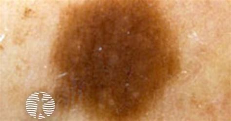 Globular Pattern Dermoscopy Image