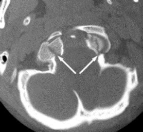 Occipital Condyle Fractures Spine Orthobullets