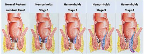 How I Cured My Horrendous Hemorrhoids In 2 Weeks Hubpages