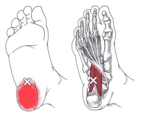 Plantar Fasciitis Trigger Points On The Feet El Paso TX Sciatica Pain And Treatment Clinic