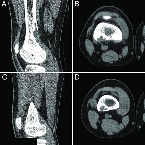 Ossifying Fibroma Femur Management Of Paediatric Benign Bone Tumour
