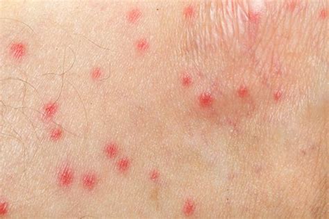 Are Bed Bugs Detrimental To Your Health