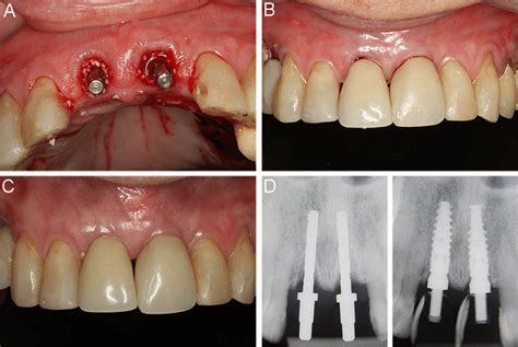 A To Fill The Gap Between The Implant And The Bone Defect Particulate Download Scientific