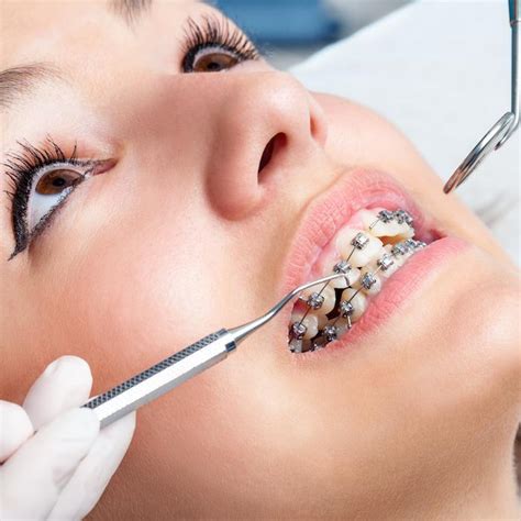 What To Do When Your Brackets Break Brendan D Smith DDS MS Orthodontist