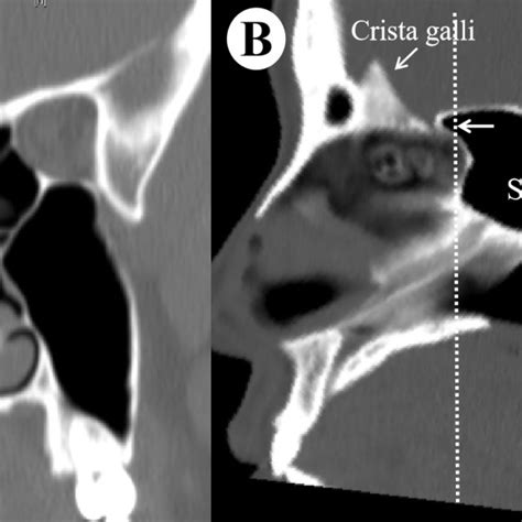 Keros Classification According To Gender Among Different Studies N