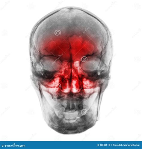 Sinusitis Film X Ray Of Human Skull With Inflamed At Sinus Stock