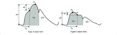 Aortic Pulse Wave Analysis Type A Waveform Reflecting Wave During