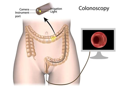Colonoscopy Prepration Procedure Dr Piyush Ranjan