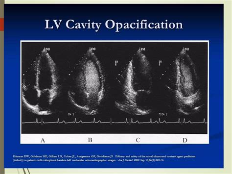Lv Systolic Function PPTX