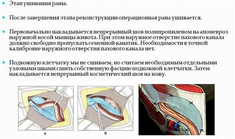 Грыжа Паховая У Мужчины Операция Диета — Похудение Диета Правильное Питание