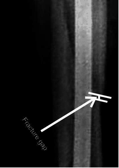 The Fracture Gap Of Main Fragments Were Measured By Distance Between