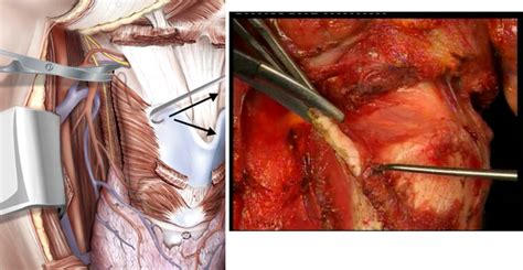 Partial Laryngectomy