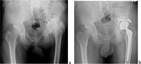 Proximal Acetabular Component Placement Download Scientific Diagram