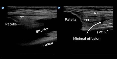 Sound Bite 4 Knee Effusion — Pocus Uk