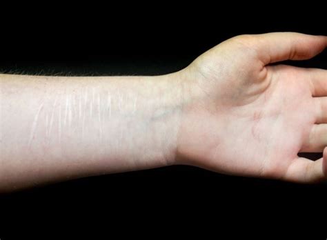 Self Injurious Behaviors Part 2 Management And Treatment