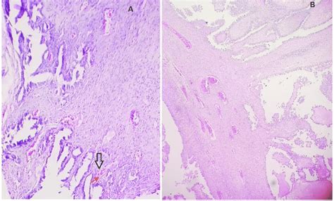 A Case Of Lvsi Compared To The Normal Subject Download Scientific