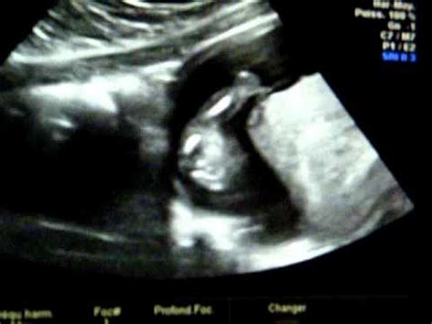 Echographie Sex Du Bb 4mois MP4 YouTube