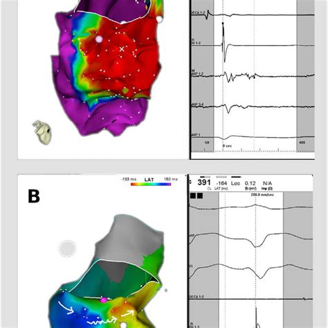 Pace Mapping To Identify And Validate Clinical Ventricular Tachycardia Download Scientific