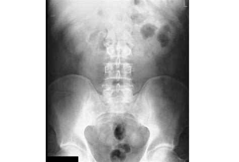 Intestinal Disorders Radiographs To Test Your Skills