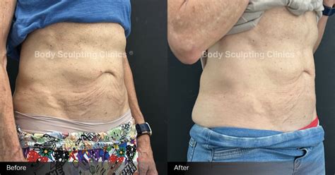 Fat Removal With Hifu Treatment Body Sculpting Clinics
