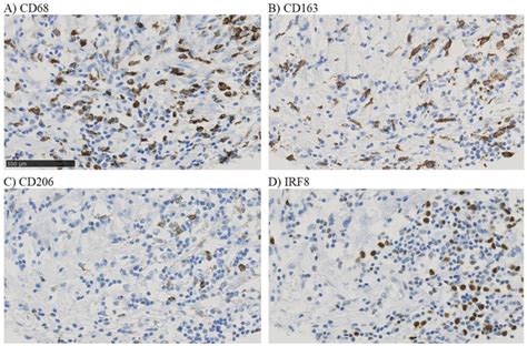 Association Of Cd206 Protein Expression With Immune Infiltration And