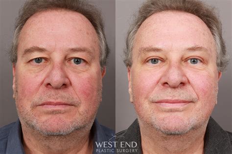 Deep Plane Facelift Neck Lift Lip Lift Eyelid Lift Brow Lift Fat Grafting And Co