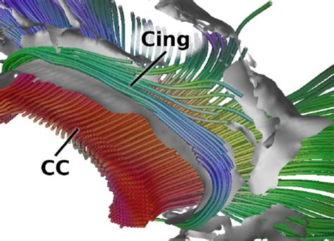 A Valley Surface In Fractional Anisotropy Gray Separates The Right Download Scientific
