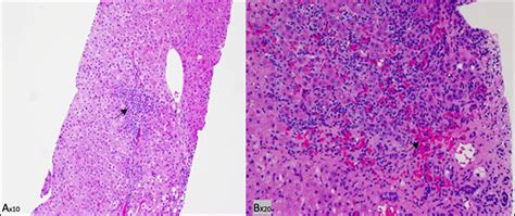 Fibrosing Cholestatic Hepatitis Masquerading Acute Rejection Acg