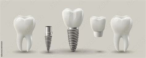 Diagram Showing Natural Teeth Alongside Dental Implants Highlighting