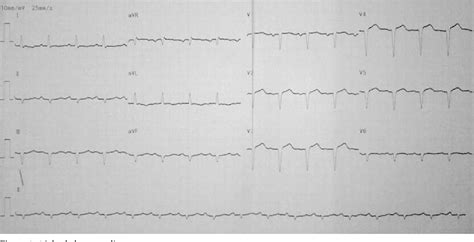 Figure 1 From Dobutamine Stress Echo For Myocardial Viability Assessment Semantic Scholar
