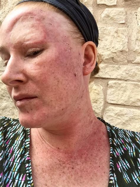 Womans Incredible Skin Cancer Photo Diary Shows The Reality Of Melanoma