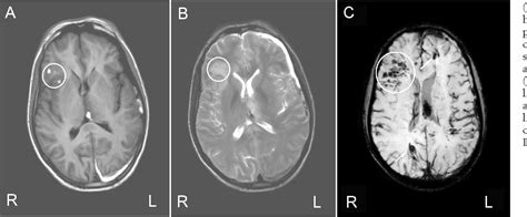 Diffuse Axonal Injury
