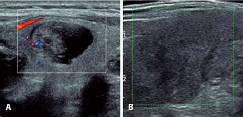 Correlation Of Thyroid Imaging Reporting And Data System [ti Rads] And Fine Needle Aspiration