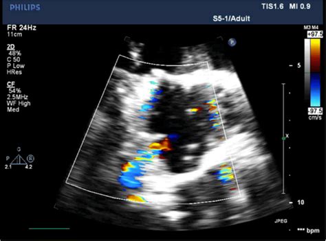 echocardiography color flow mapping image reflecting mild to moderate