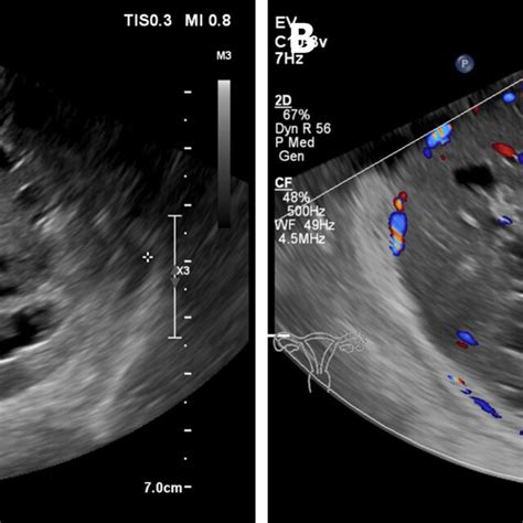 Ultrasound Scan A An 87 Mm × 60 Mm Mass With A Heterogeneous Echo Is Download Scientific