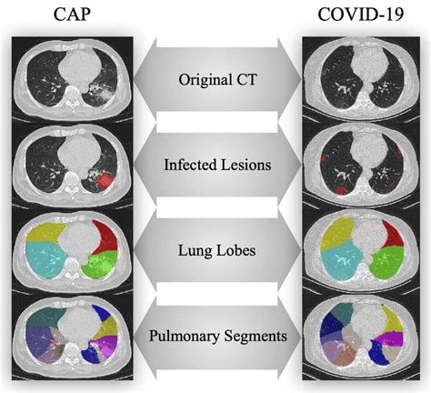 Lung Segments Ct Anatomy Right Lower Lobe Segmentation Cpam In Extra