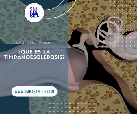 🛡¿qué Es La Timpanoesclerosis 👂 La Timpanoesclerosis Es Una Afección