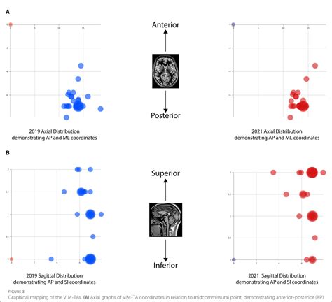 Figure 3 From The Evolution Of Ventral Intermediate Nucleus Targeting In Mri Guided Focused