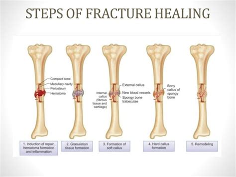 Factors Affecting Fracture Healing Pptx